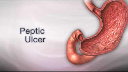 All you need to know about Peptic Ulcer - StocksWatch